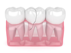 Types of Root Fractures and Their Treatment Options - Burien Endodontics