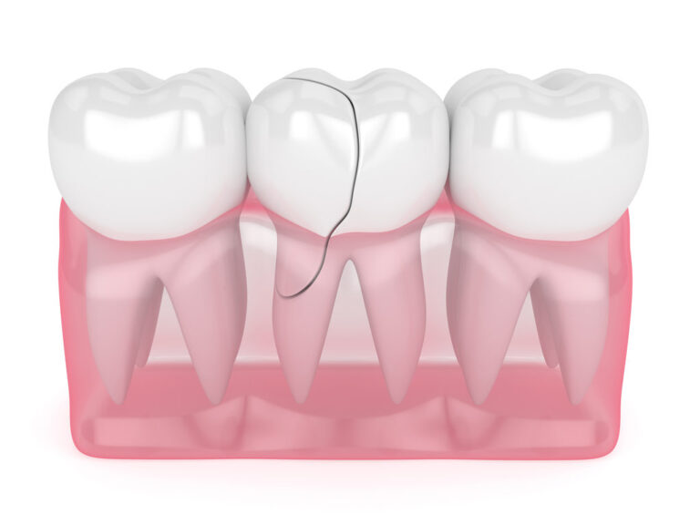 Types of Root Fractures and Their Treatment Options - Burien Endodontics